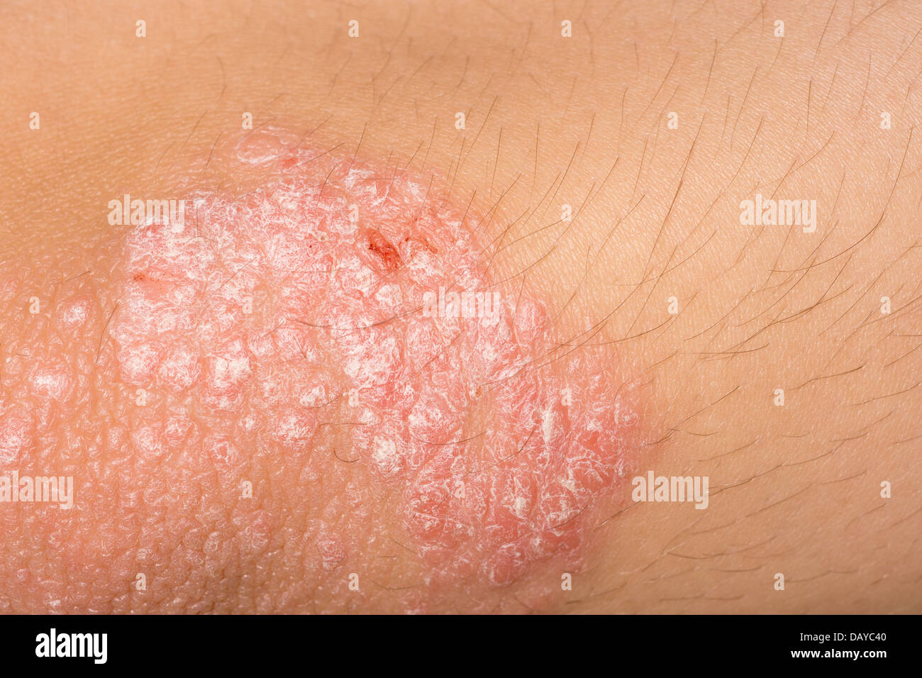 Psoriasis en plaques Banque de photographies et d’images à haute ...
