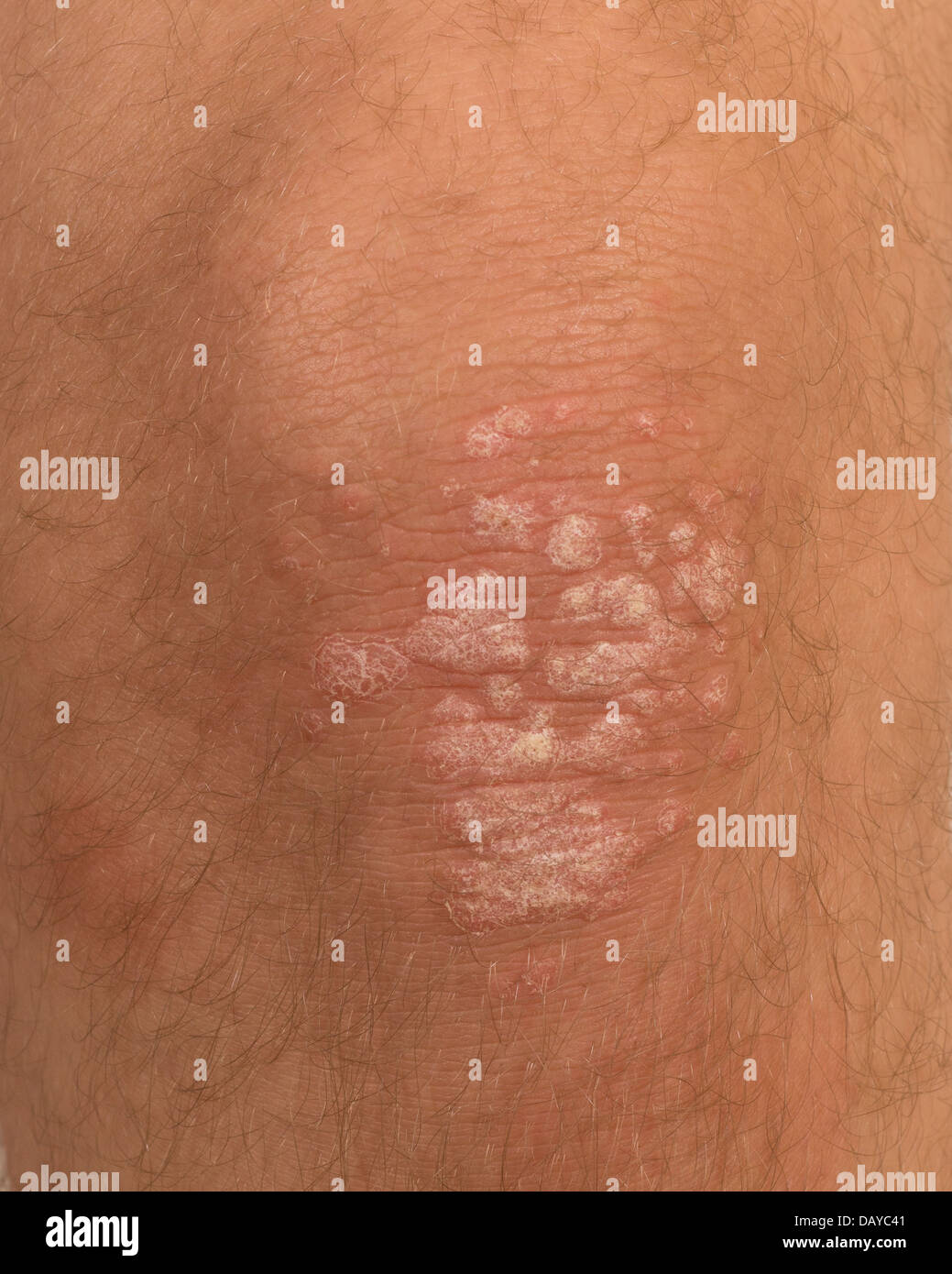 Psoriasis en plaques Banque de photographies et d’images à haute ...