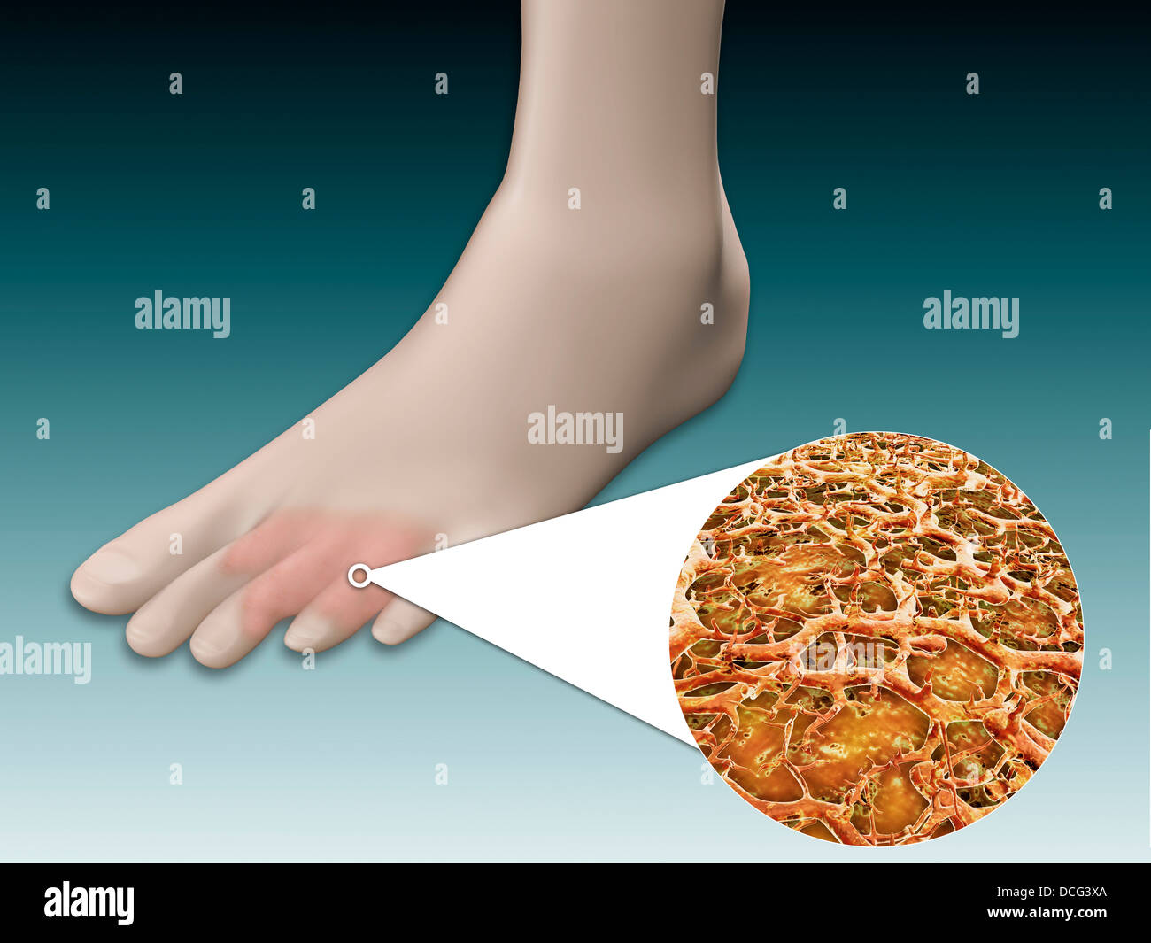 Mycose cutanée Banque de photographies et d’images à haute résolution ...