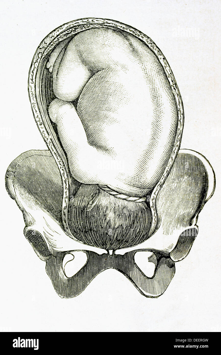 Abnormal fetus Banque de photographies et d’images à haute résolution ...