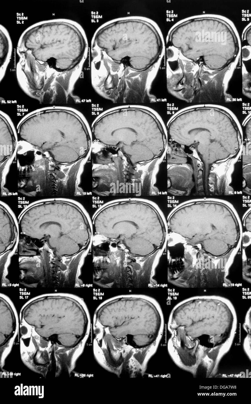 Qui sont le plan sagittal Banque de photographies et d’images à haute ...