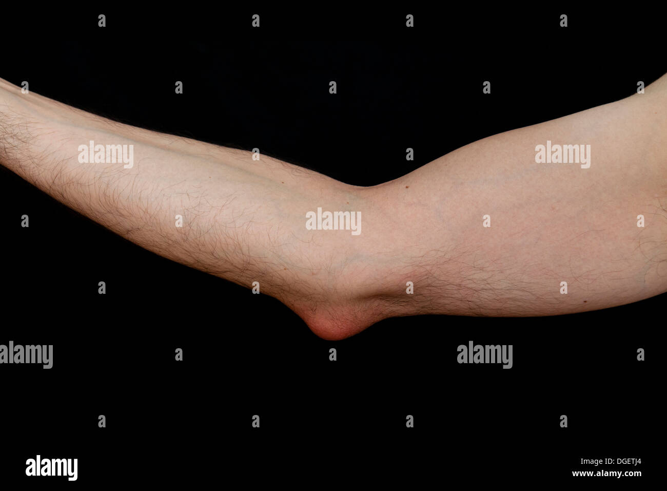 Olecranon bursitis, est une maladie causée par l'inflammation de la ...