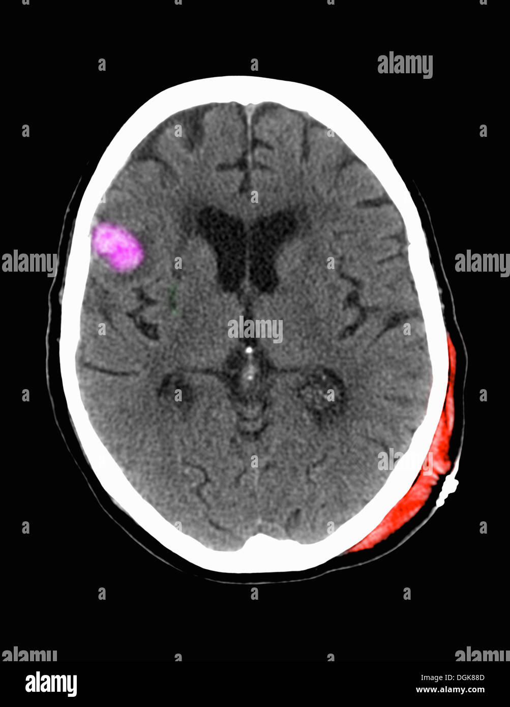 Contusion cérébrale Banque de photographies et d’images à haute ...