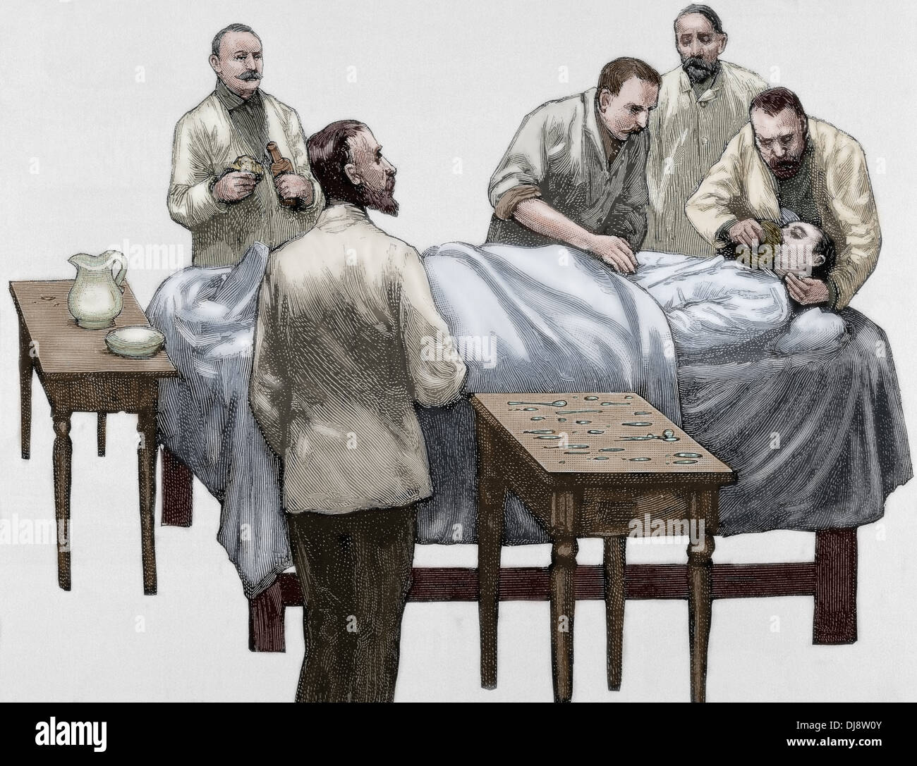 Histoire de la médecine. L'anesthésie au chloroforme. Gravure, 19ème ...