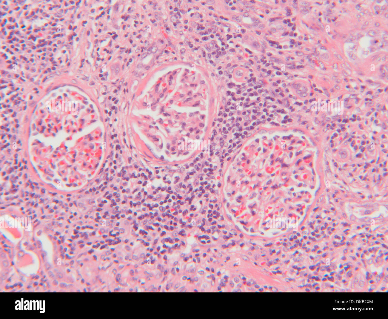 Micrographie histologie de l'insuffisance rénale, néphrite ...