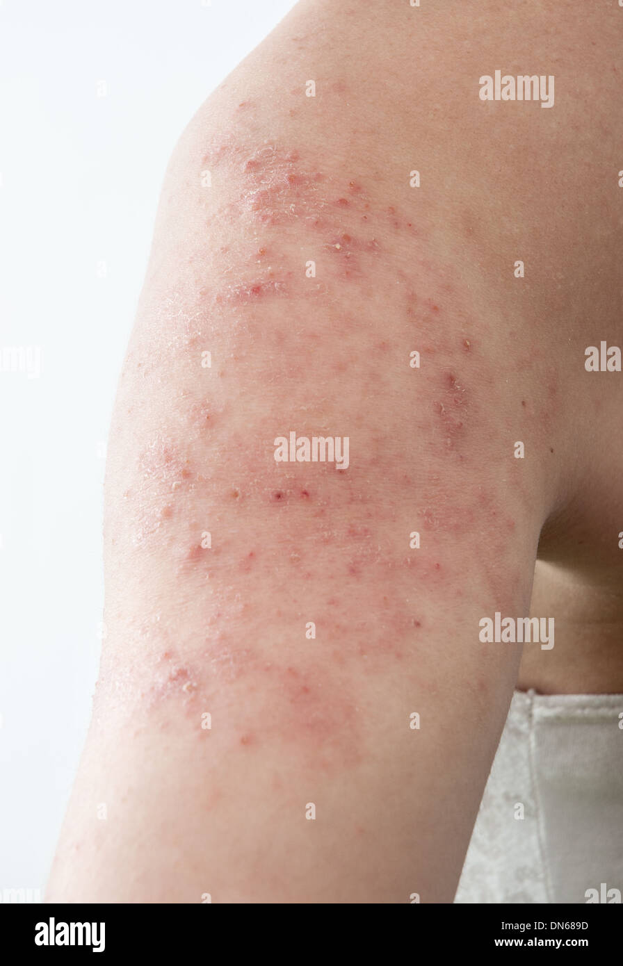 Éruption allergique Dermatite atopique la texture de la peau du patient ...