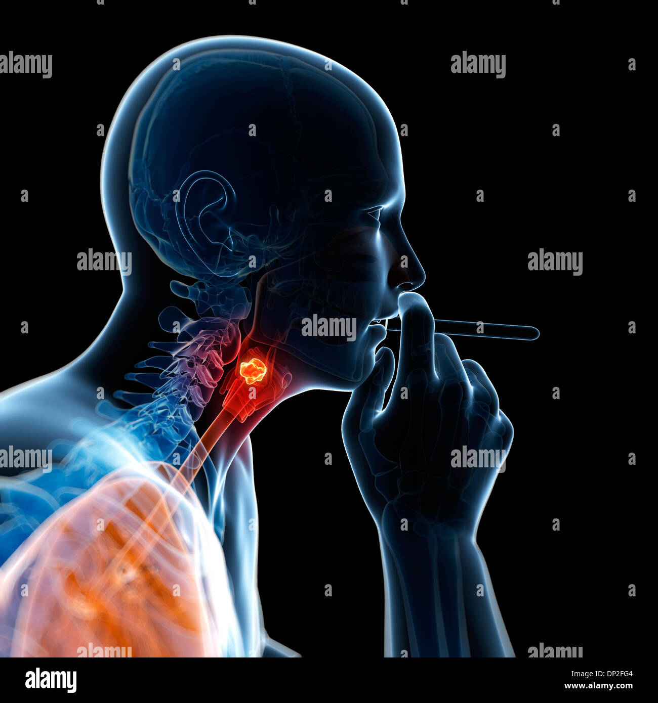 Larynx cancer artwork Banque de photographies et d’images à haute ...