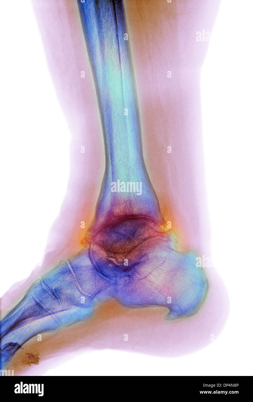 Arthrose de la cheville Banque de photographies et d’images à haute ...
