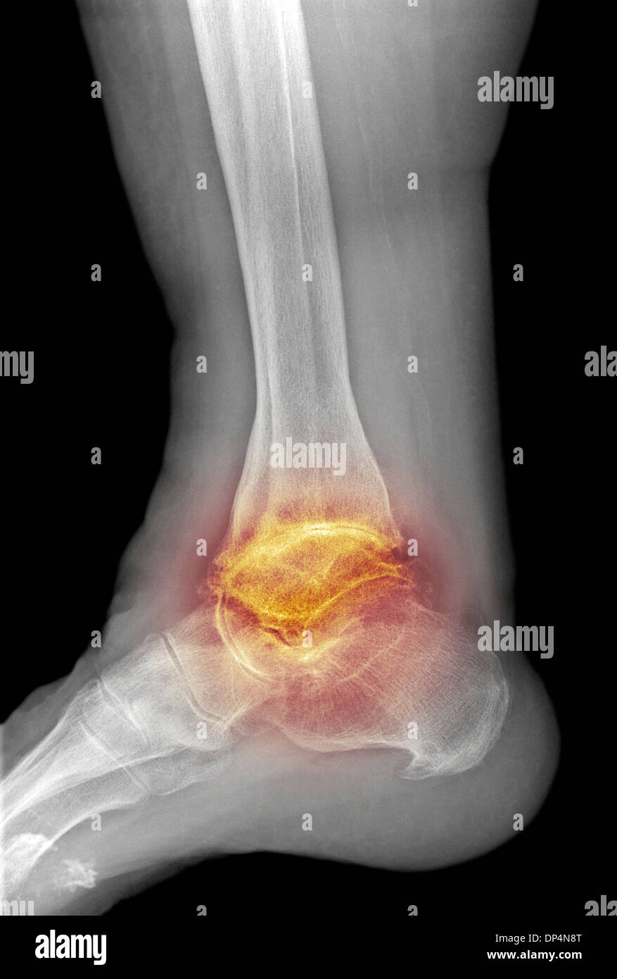 Arthrose de la cheville Banque de photographies et d’images à haute ...