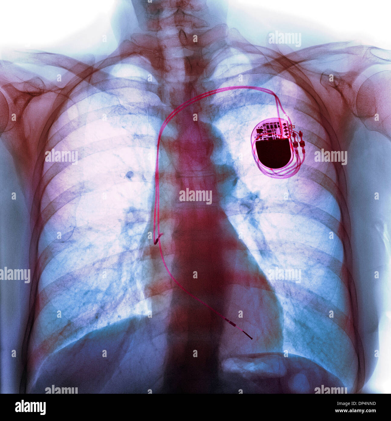 Radiographie du stimulateur cardiaque Banque de photographies et d ...