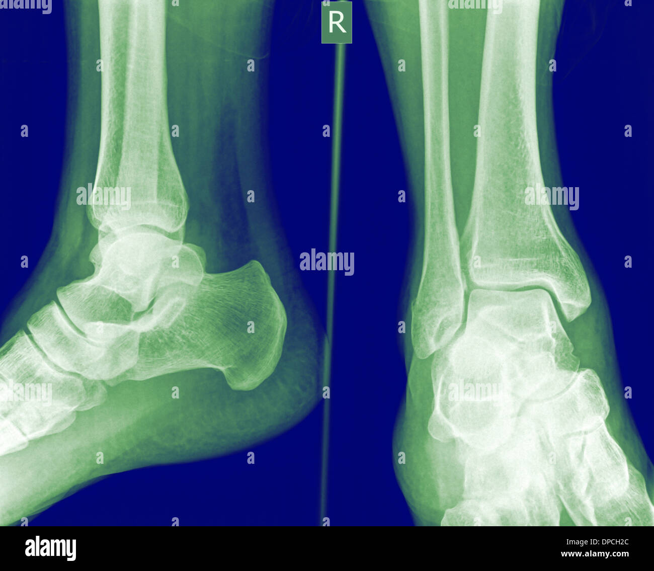 X-ray d'une cheville droite d'un homme de 43 ans patient avec une ...