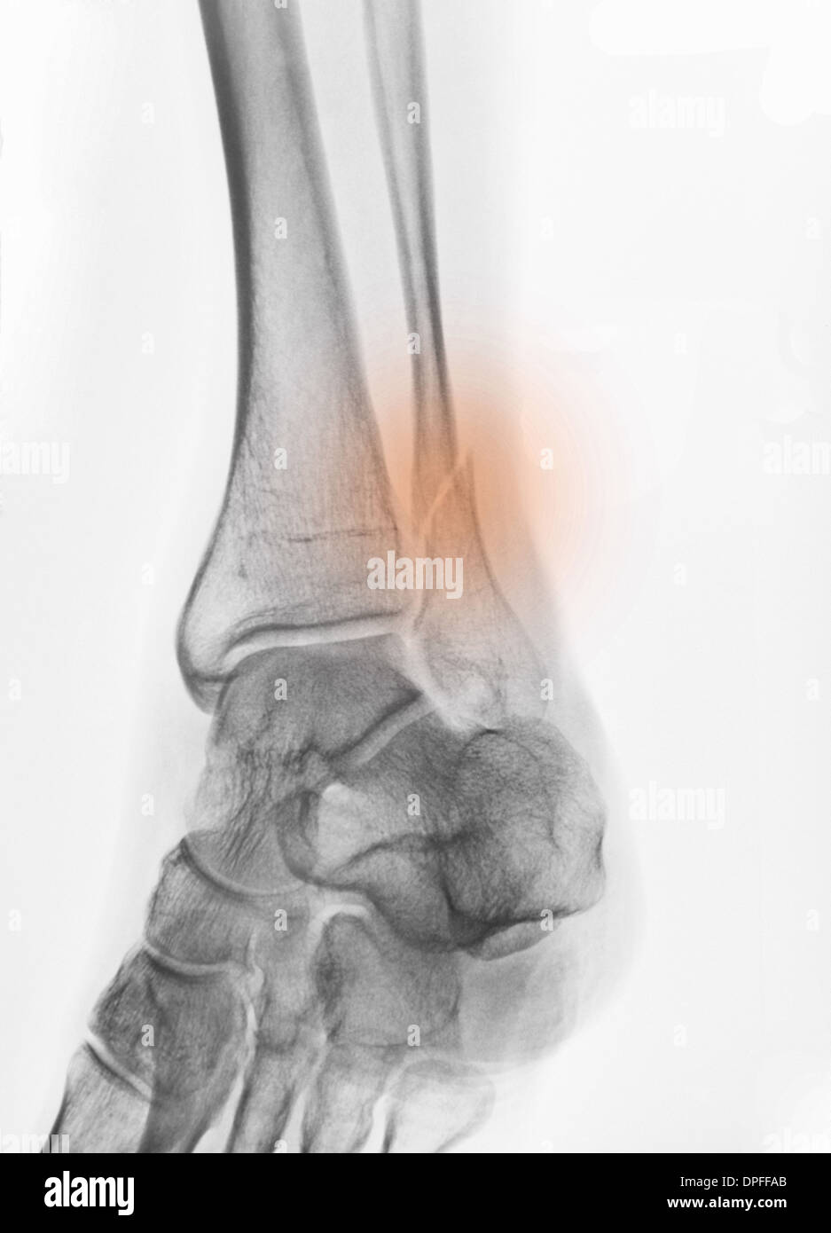 Distal fibula fracture Banque de photographies et d’images à haute ...