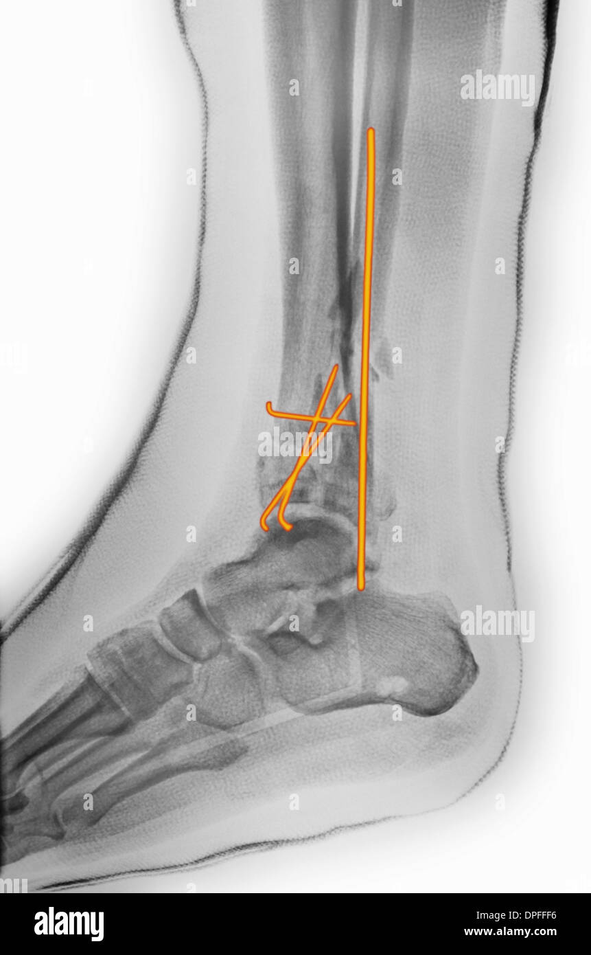 Radiographie d'une fracture de la cheville après la chirurgie Photo ...