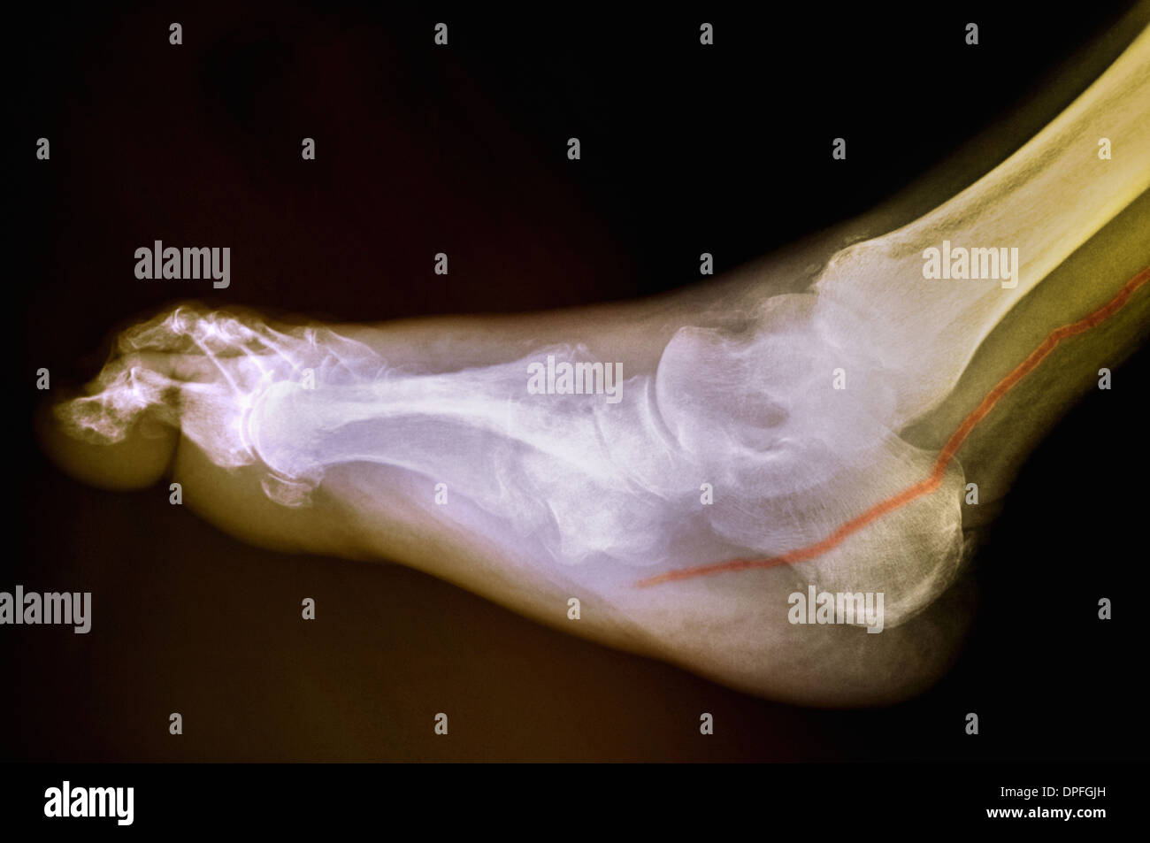 Pied diabétique Banque de photographies et d’images à haute résolution ...