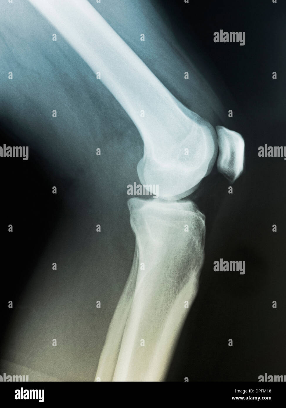 Radiographie normale Banque de photographies et d’images à haute ...