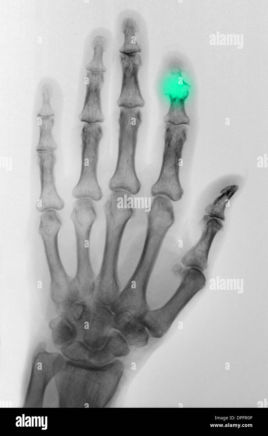 Radiographie des mains arthrose Banque de photographies et d’images à ...