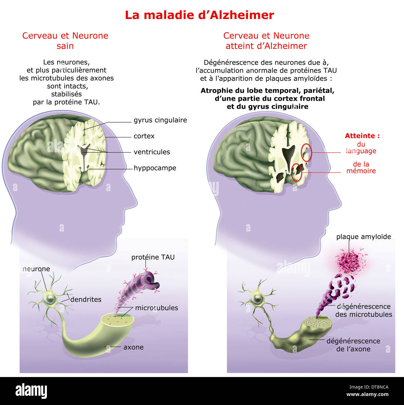 Maladie alzheimer Banque de photographies et d’images à haute ...