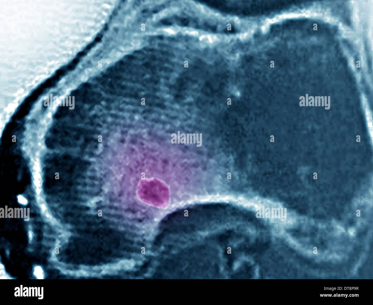 Ostéome OSTÉOÏDE IRM Photo Stock - Alamy