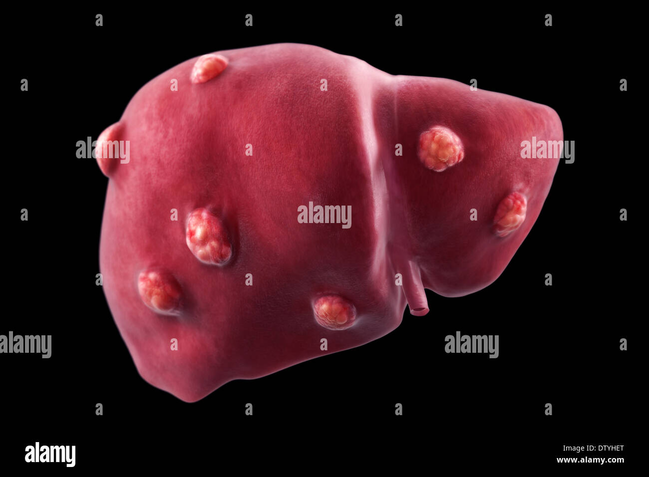 Cancer du foie Photo Stock - Alamy