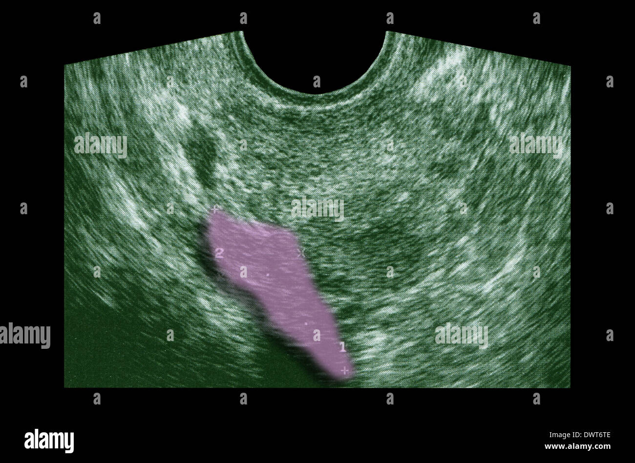 Uterine mucosa Banque de photographies et d’images à haute résolution ...