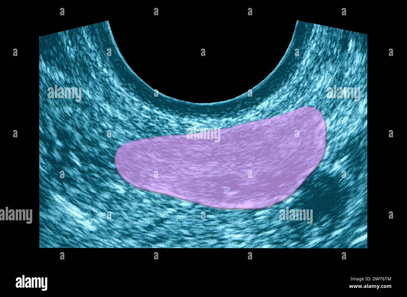 Pelvic ultrasound Banque de photographies et d’images à haute ...