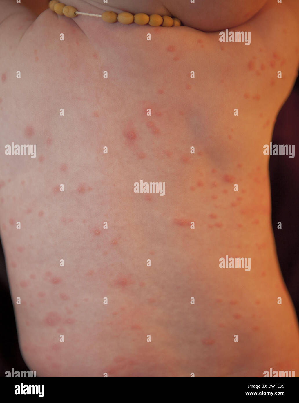 Varicelle bébé Banque de photographies et d’images à haute résolution ...