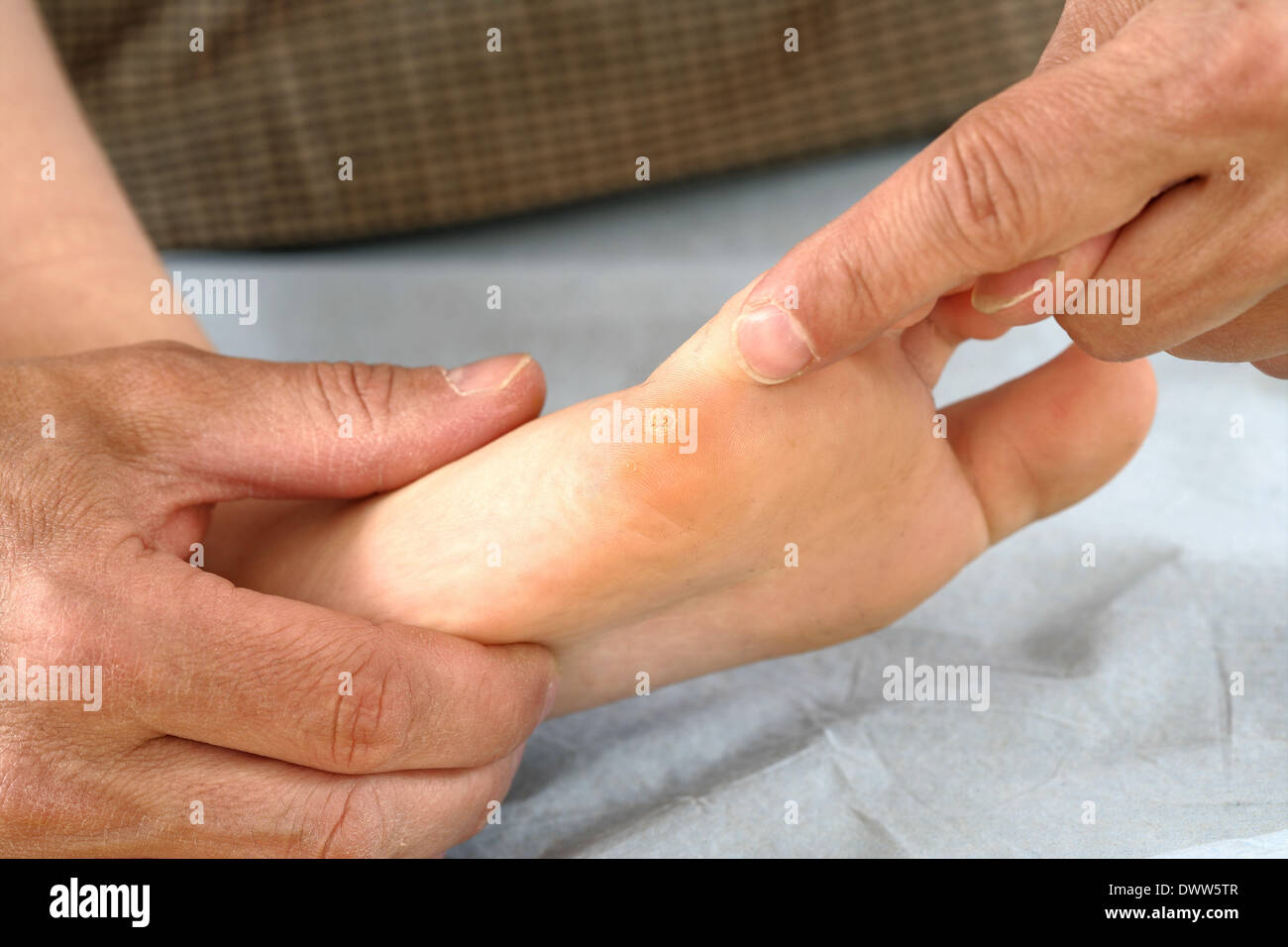 Verrue plantaire Banque de photographies et d’images à haute résolution ...