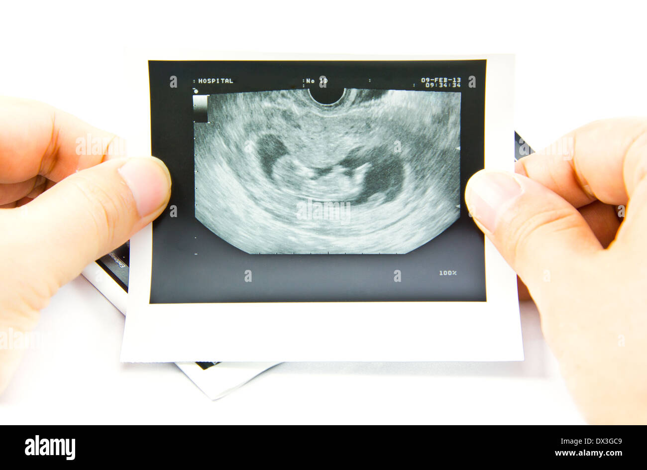 Fetus 12 weeks Banque de photographies et d’images à haute résolution ...