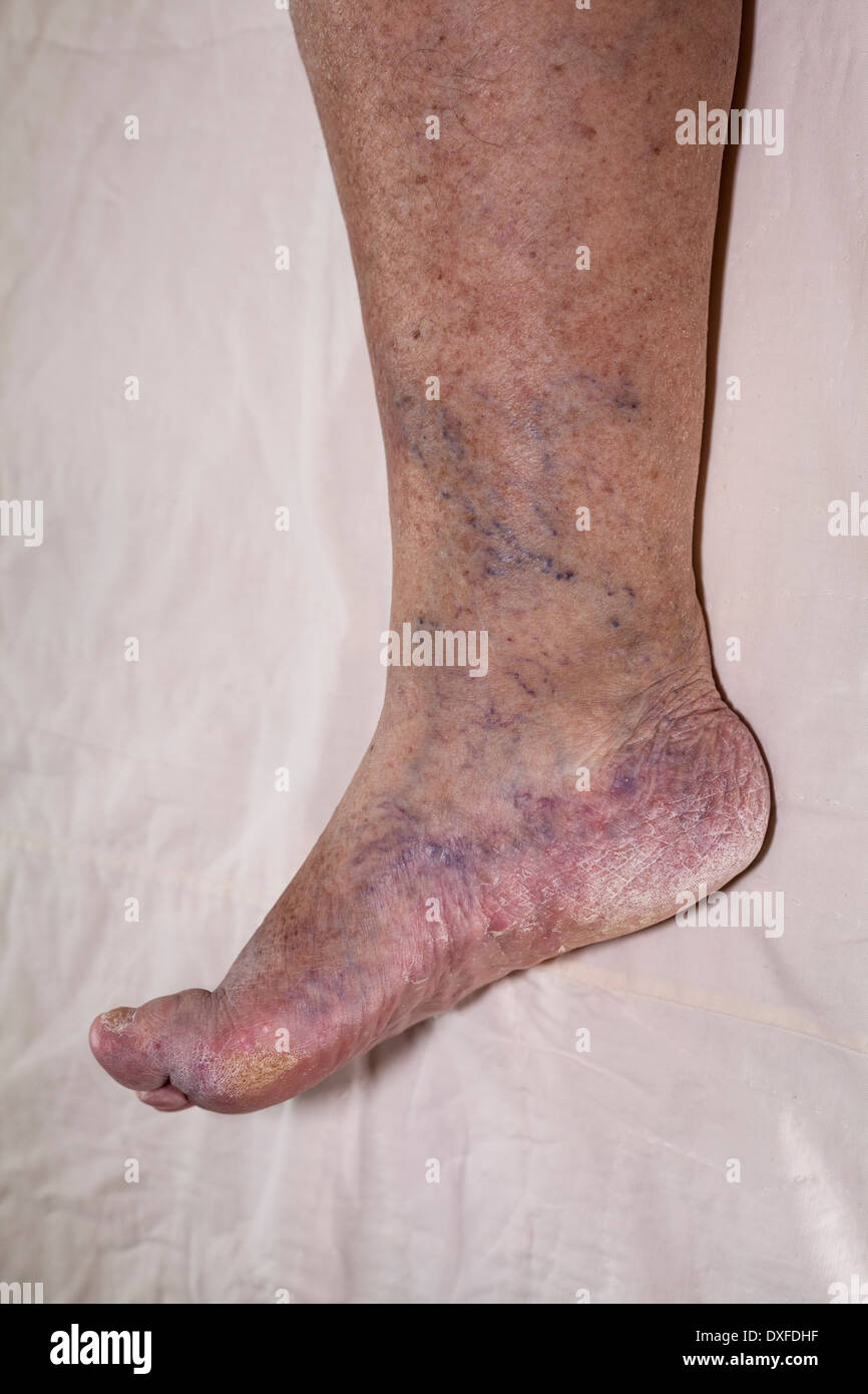 Mycose cutanée Banque de photographies et d’images à haute résolution ...