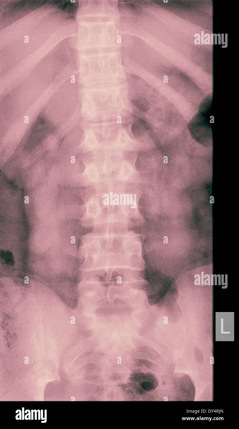 X-ray de fracture par tassement de vertèbre L2 de 14 ans homme, front ...