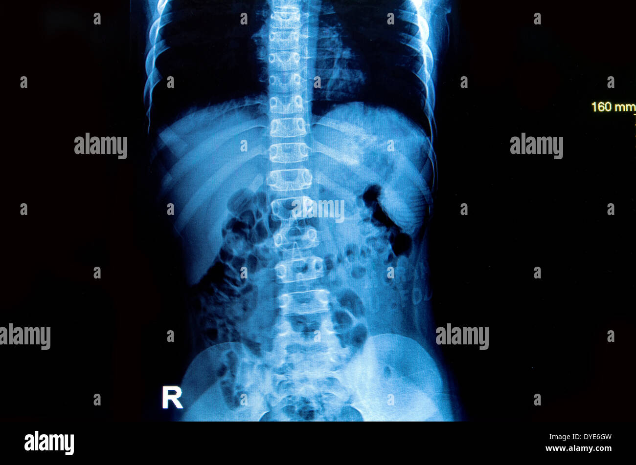 X-ray image (colonne vertébrale et du bassin d'un corps humain Photo ...