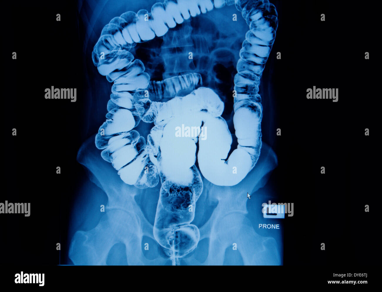 Barium enema x ray Banque de photographies et d’images à haute ...