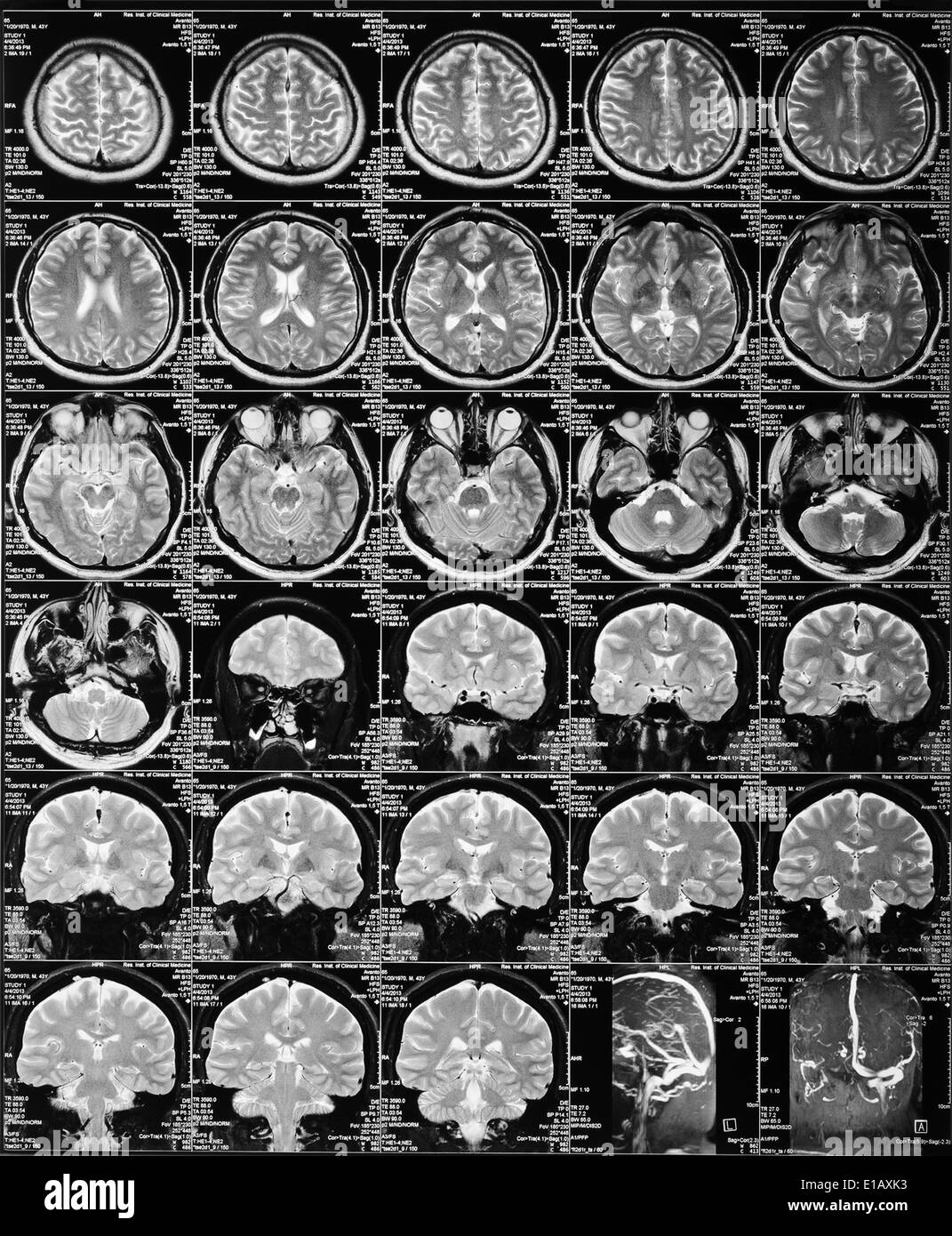 Irm du cerveau crâne X-ray Photo Stock - Alamy