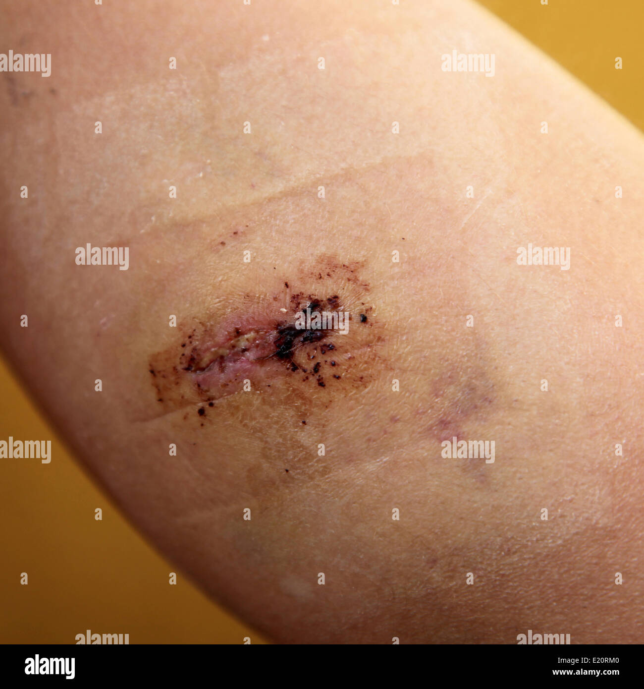 Blessure de la plaie Banque de photographies et d’images à haute ...