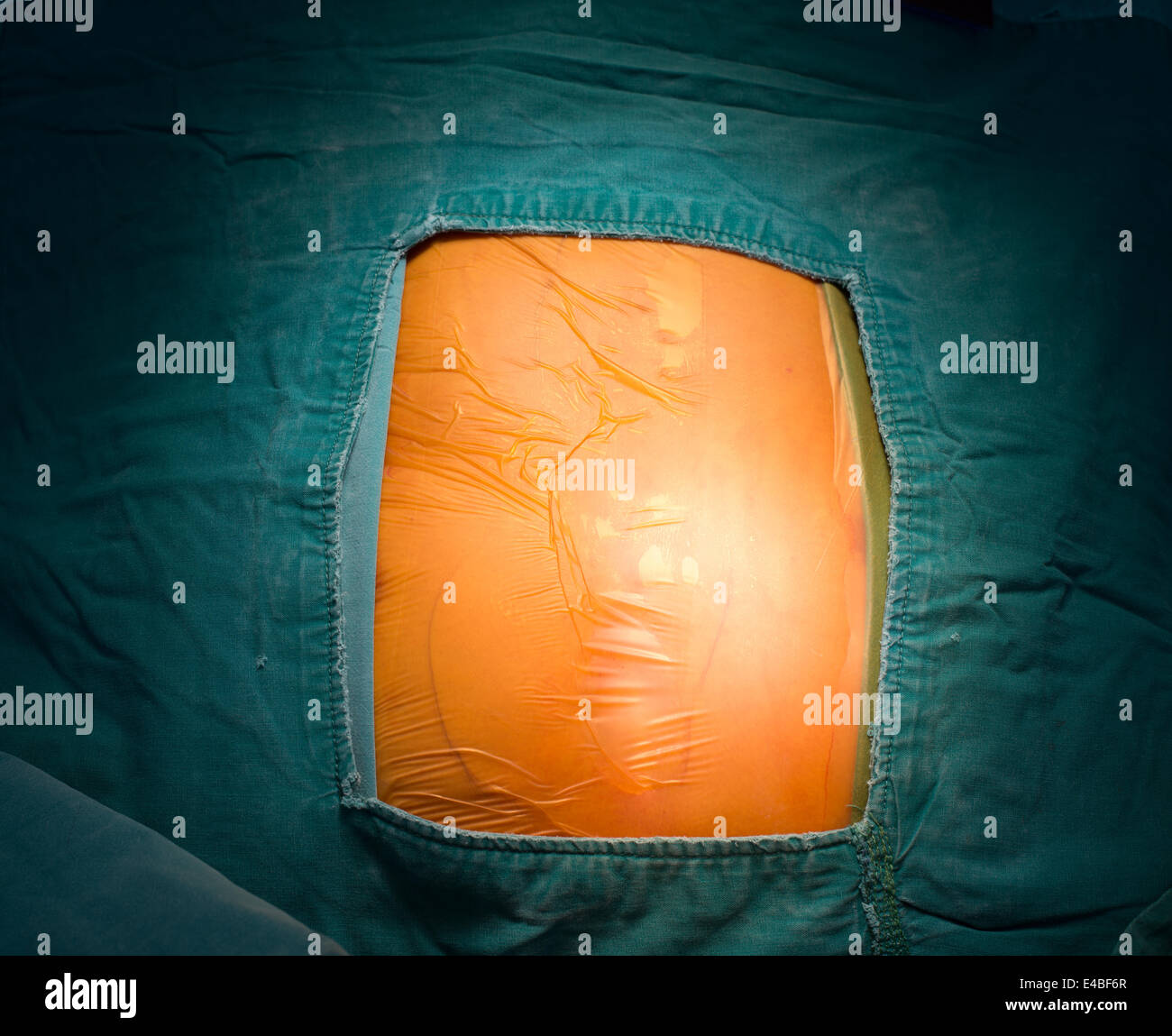 Incision chirurgicale Banque de photographies et d’images à haute ...