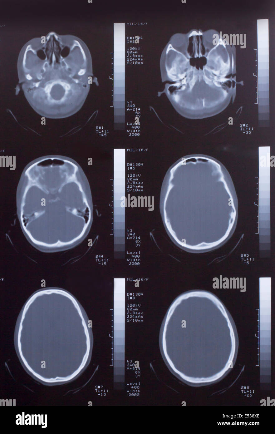 Scanner cerveau Banque de photographies et d’images à haute résolution ...