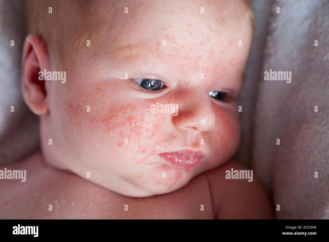 Erythema toxicum neonatorum etn is of Banque de photographies et d ...