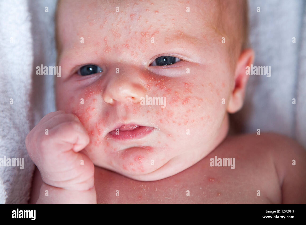 Erythema toxicum neonatorum etn is of Banque de photographies et d ...