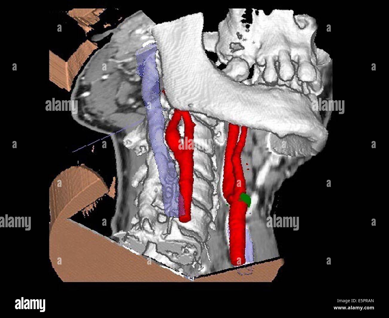 Anévrisme carotide Banque de photographies et d’images à haute ...