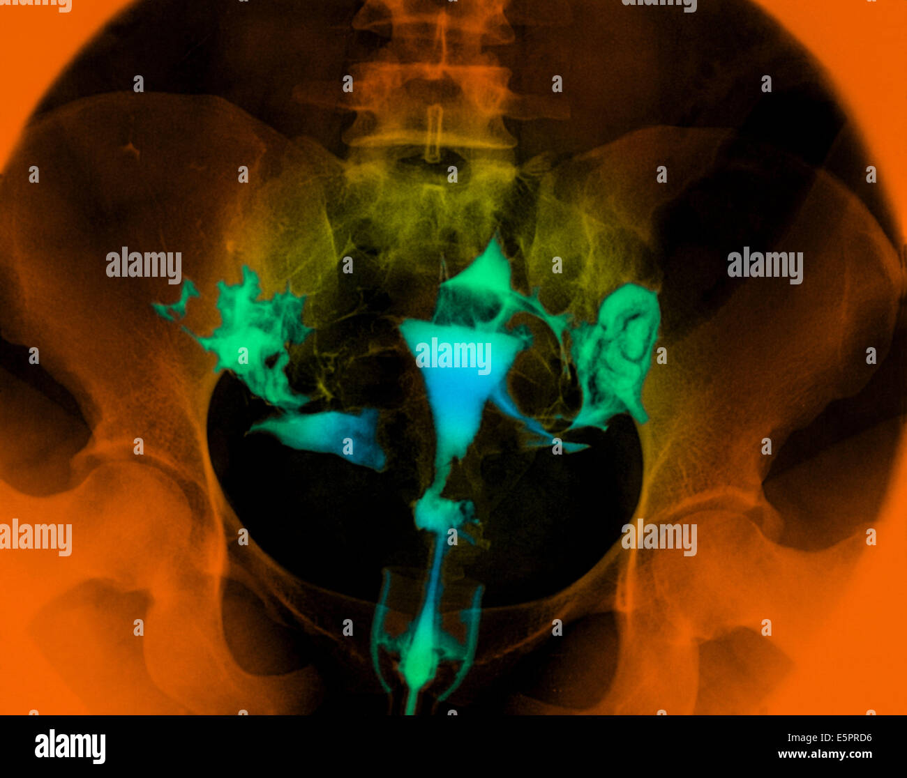 X-ray des organes reproducteurs femelles. Un produit de contraste a été ...