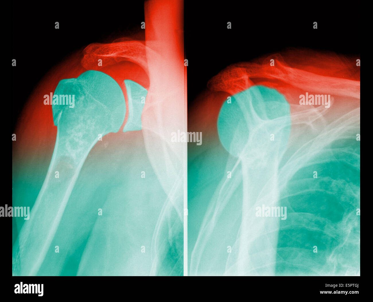 X-ray de couleur montrant une luxation de l'épaule de qualité ...