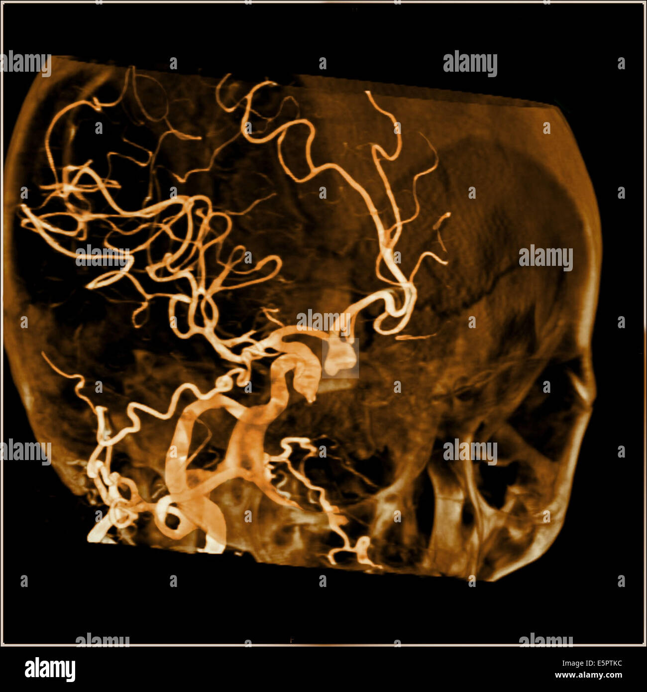 À partir de la reconstruction 3D et l'angiographie CT scanner du crâne ...