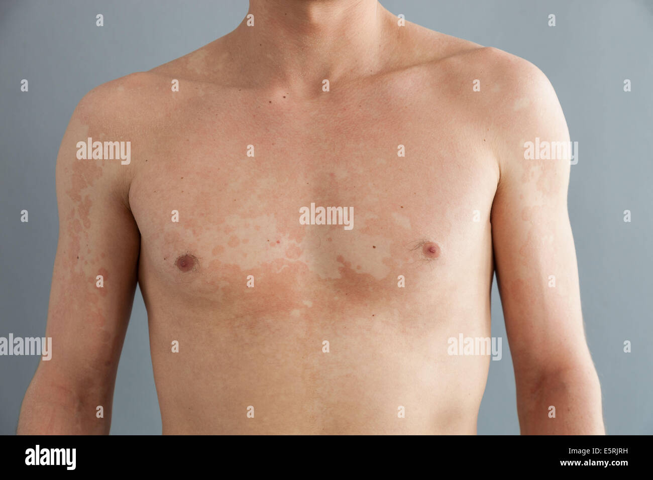 Pityriasis versicolor de la peau en 18 ans homme patient, montrant les ...