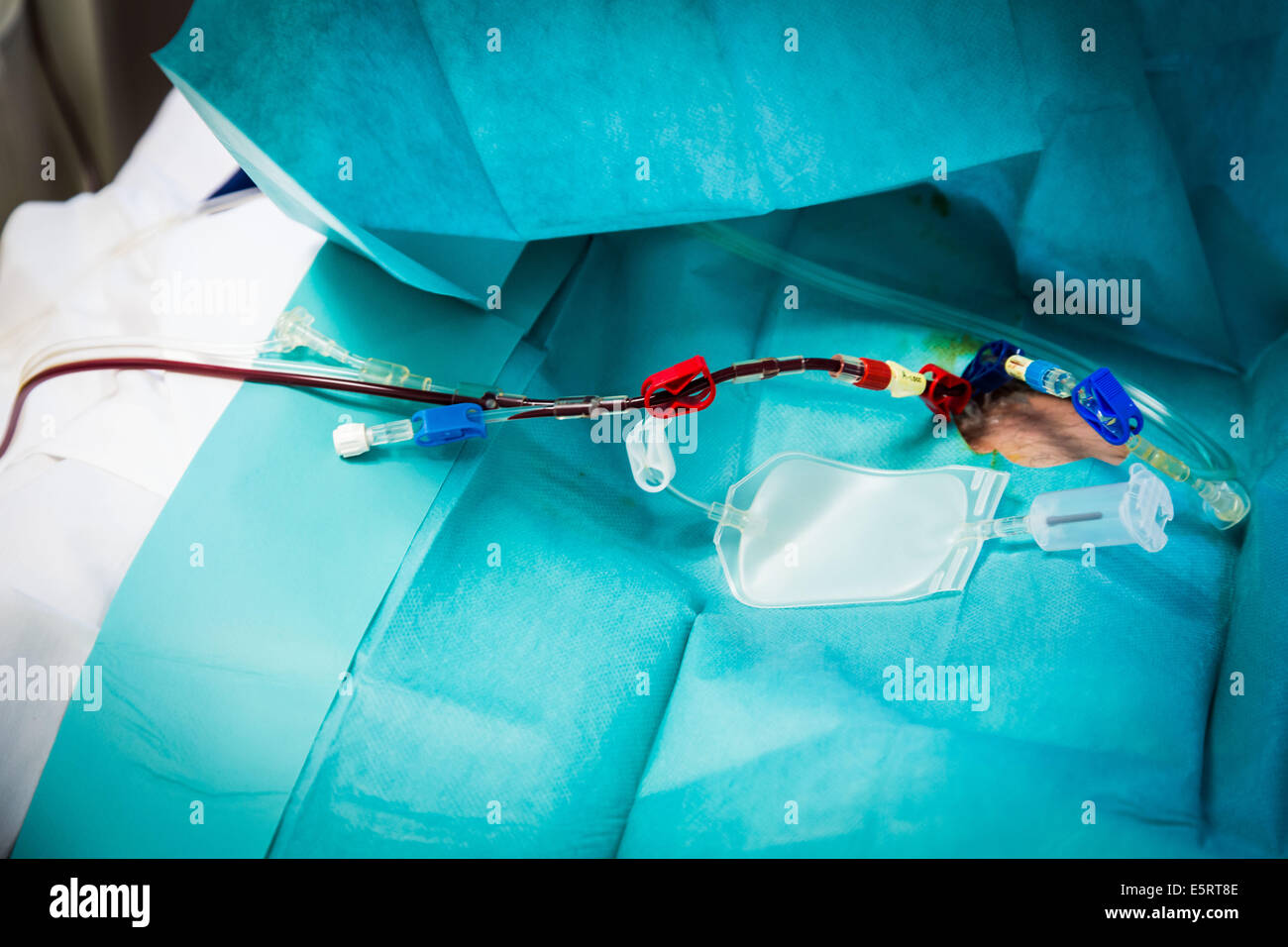 Les cellules souches du sang périphérique (PBSC) don par aphérèse ...