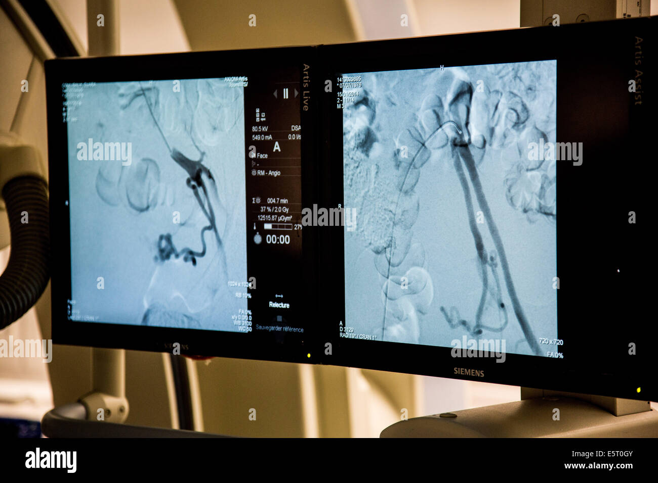 Léiomyome utérin Banque de photographies et d’images à haute résolution ...