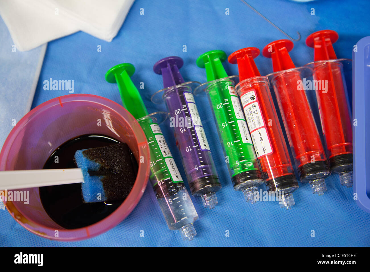 Léiomyome utérin de traitement par embolisation, Hôpital Européen ...