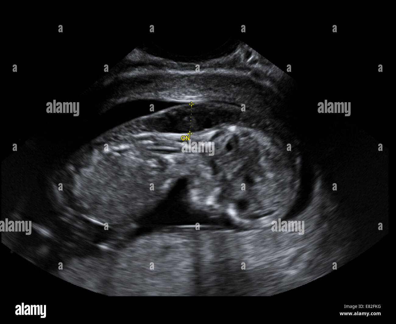 Échographie Dun Fœtus Montrant Nuchal Du Scan Pour Le Syndrome De Down