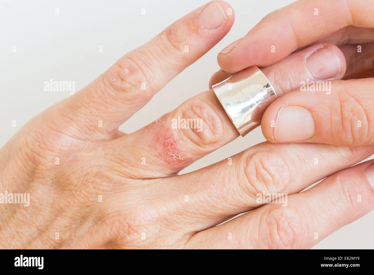 Dermatitis de contacto Banque de photographies et d’images à haute ...