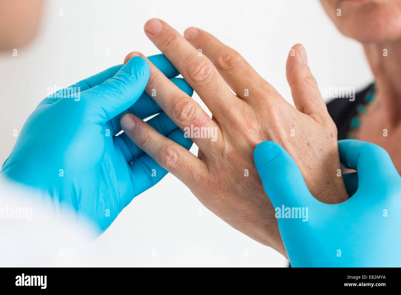 La dermatite de contact sur le doigt Photo Stock - Alamy