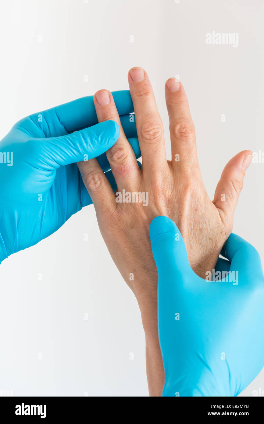 La dermatite de contact sur le doigt Photo Stock - Alamy